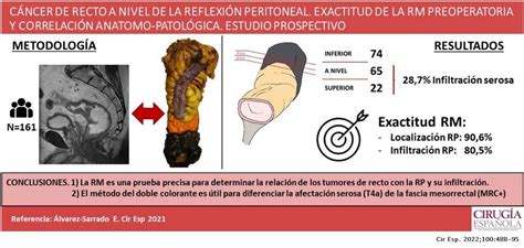 Peritoneal Reflection Sigmoid