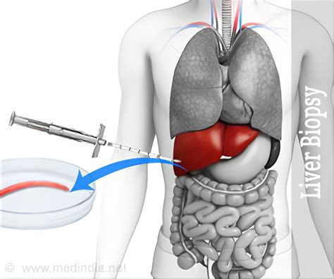 Liver Biopsy Needle