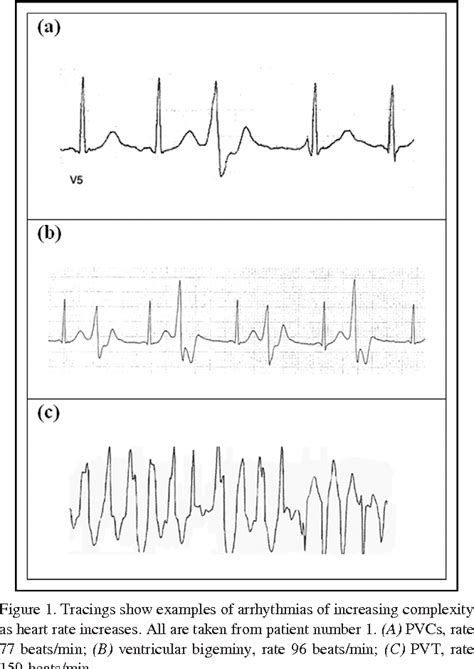 Polymorphic Ventricular Tachycardia Vs Ventricular Fibrillation Polymorphic Ventricular Tachycardia Vs Ventricular Fibrillation