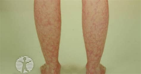 Livedo Reticularis Image