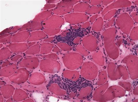 Myositis Treatment Myositis Uk