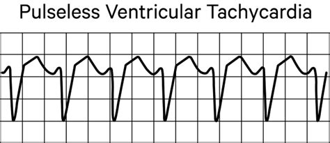 What Is Pulseless Ventricular Tachycardia Iytmed Com