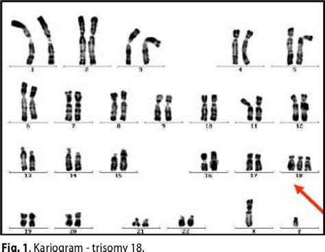 Edwards Syndrome Chromosomes