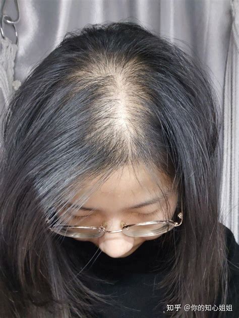 一名脱发患者的改善经历（有更新） 知乎