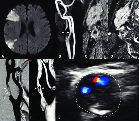 Diffusion Weighted Imaging A Revealed A Watershed Infarct In The