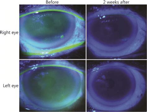 Slit Lamp Fluorescein Corneal Staining Pictures Showed That Inferior Download Scientific