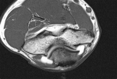 The Radiology Assistant Mri Examination Of The Elbow