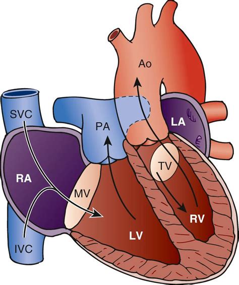 Surgery For Congenitally Corrected Transposition Of The Great Arteries