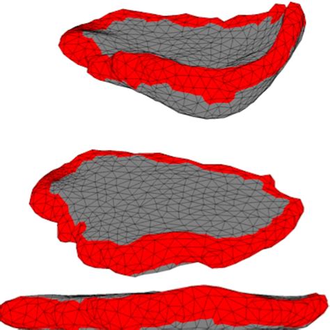 New Technique Unravels 3d Mri Scans Of Placenta Auntminnie
