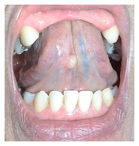 Ventral Tongue Lesions Peripheral Exophytic Oral Lesions A Clinical