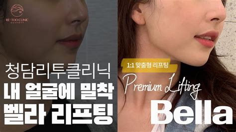 벨라리프팅 시술 전 후 And 설명 L 청담리투클리닉 Youtube