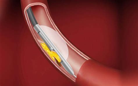 Rotational Atherectomy Catheter