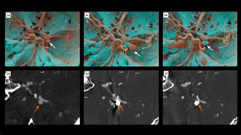 Follow Up On An Endovascular Coiling Embolization Of A Ruptured Intracranial Aneurysm Siemens