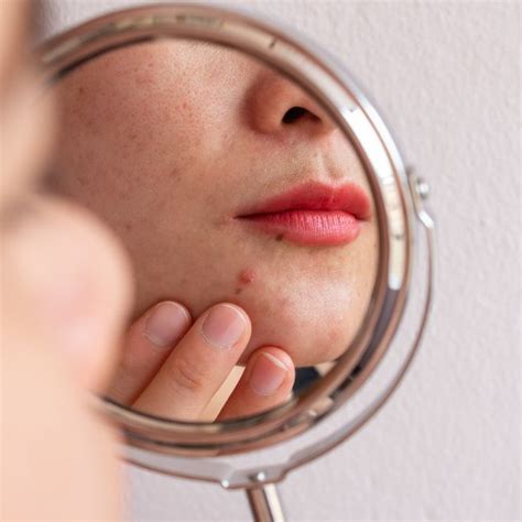 Conheça Os Tipos De Acne Blog Océane