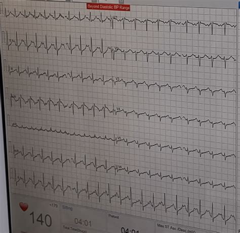 Does Ekg Show Wpw Pattern R Readmyecg