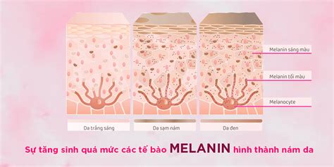 NÁm LÀ GÌ PhÂn LoẠi NÁm NguyÊn NhÂn GÂy Ra NÁm Da Jenna Thanh