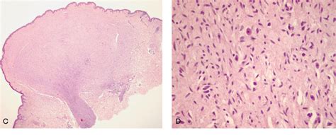 Figure 1 From Segmental Neurofibromatosis A Rare Variant Of A Common Genodermatosis Semantic