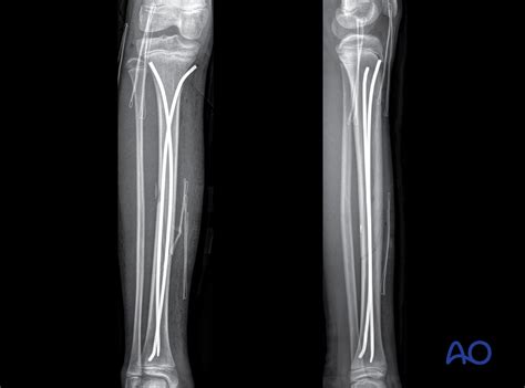 Anatomia Tibial