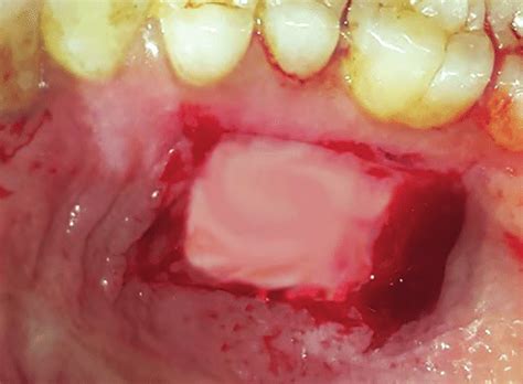 Case 1 Free Gingival Graft Harvested Fig 4 Case 1 Free Gingival