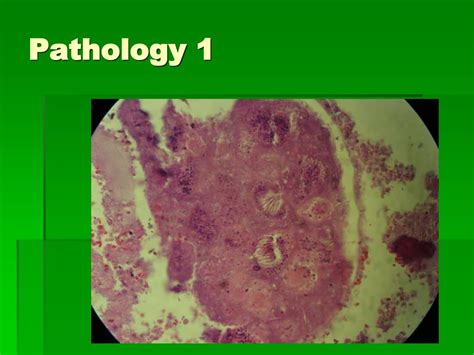 Ppt Pulmonary Echinococcus Powerpoint Presentation Free Download
