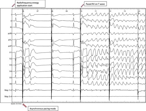 Twelve Lead Ecg Recording During Radiofrequency Ablation Energy