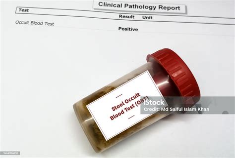 비정상적인 환자의 보고서가있는 잠혈 검사 혈액에 대한 대변 샘플을 확인하는 데 사용되는 실험실 테스트입니다 피에 대한 스톡 사진 및 기타 이미지 Istock