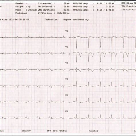 Electrocardiography Normal Sinus Rhythm T Wave Inversion And V1 V4