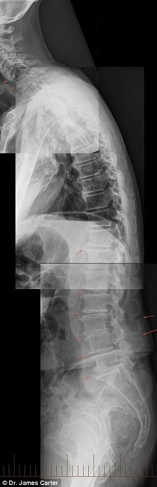 Text Neck Seen In Shocking X Rays Of Teenagers Daily Mail Online