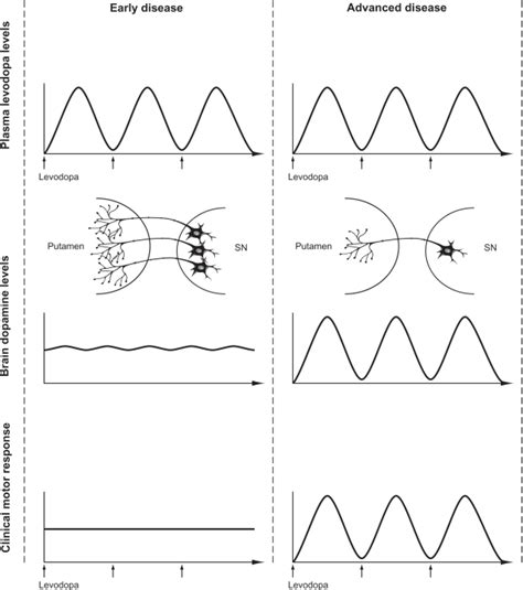 The Evolution Of Levodopa Associated Motor Fluctuations A Comparison