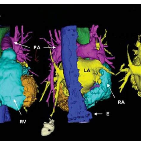 Segmentation Process Of 3d Ct Image Using Carto Merge Software