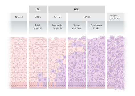 Hpv And Pap Test Results Next Steps After An Abnormal Test 46 Off