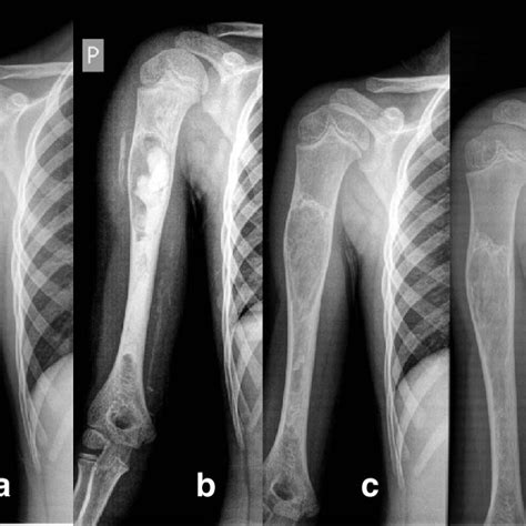 Modified Neer Classification Of Radiologic Results Download Table