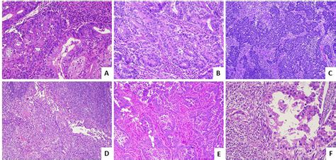 Histological Subtypes Of Endometrial Carcinoma An Overview A An