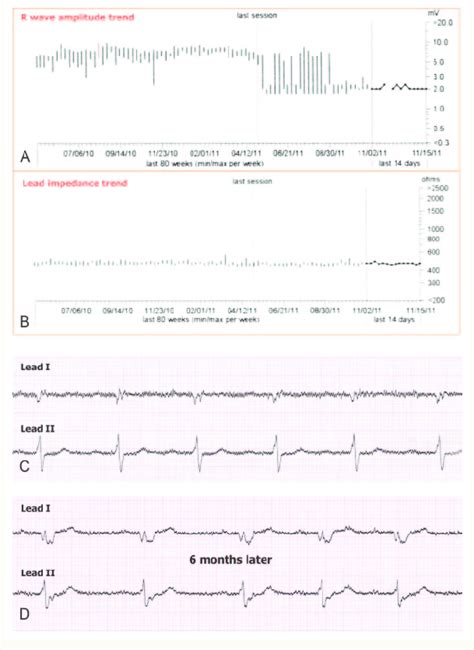R Wave Amplitude Showing A Decrease Of The R Wave From To MV Download Scientific