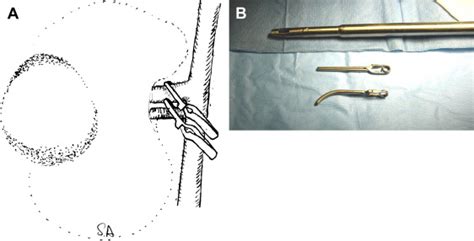 Laparoscopic Partial Nephrectomy An Update On Contemporary Issues Abdominal Key