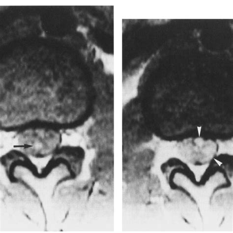 Spine Mri With Gadolinium The Lesion Of The Conus Medullaris Involving Download Scientific