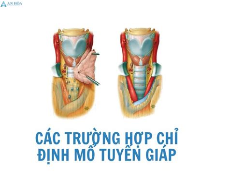 Có Nên Mổ Tuyến Giáp Không Được Và Mất Sau Khi Mổ Tuyến Giáp
