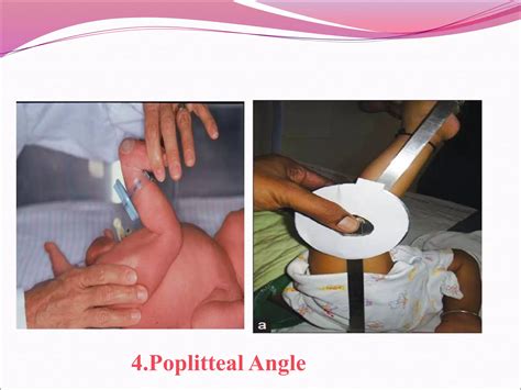 Neonatal Gestational Age Assessmentppt