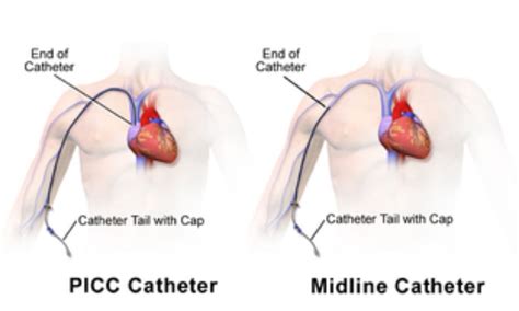 Picc Catheter