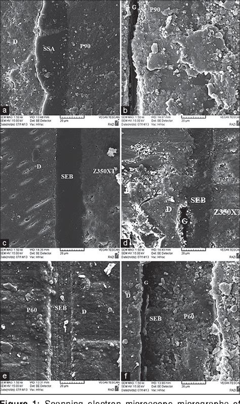Figure 1 From Comparison Of Microleakage In Class Ii Cavities Restored With Silorane Based And