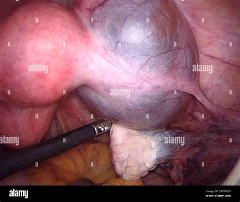 Fallopian Fibroid Laparoscopic Image Of A Fibroid Myoma Lower Centre