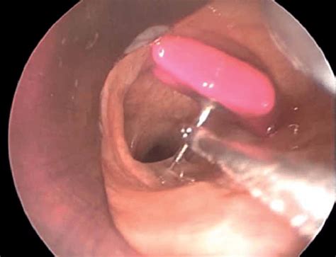 Foreign Body Removal Download Scientific Diagram