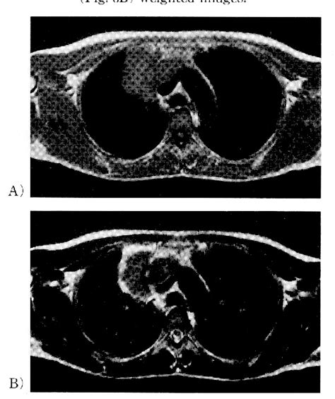 Figure 3 From A Case Of Malignant Lymphoma Hodgkins Disease In The