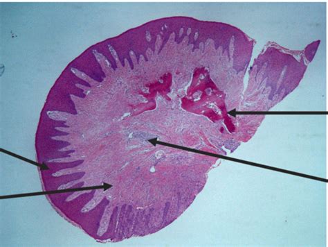 Oral Pathology 5 Soft Tissue Hyperplastic Lesions Flashcards Quizlet