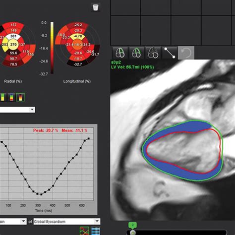 Post Processing Of Radial And Longitudinal Strain Measurements Is