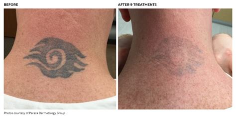 Before And After Tattoo Removal