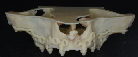 Extreme Maxillary Bone Resorption Solved With Customized Implants Ab