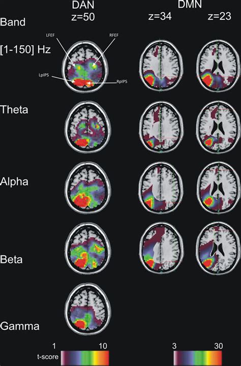 Band Specific Nonstationary Meg Connectivity Left Dorsal Attention