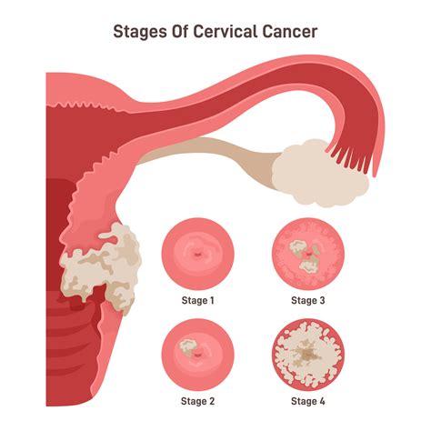 Cervical Cancer Malignant Neoplasm Arising From Cancer Cells 46422651