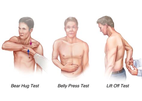 Tears Of The Subscapularis Hidden And Forgotten No More Shoulder And Elbow